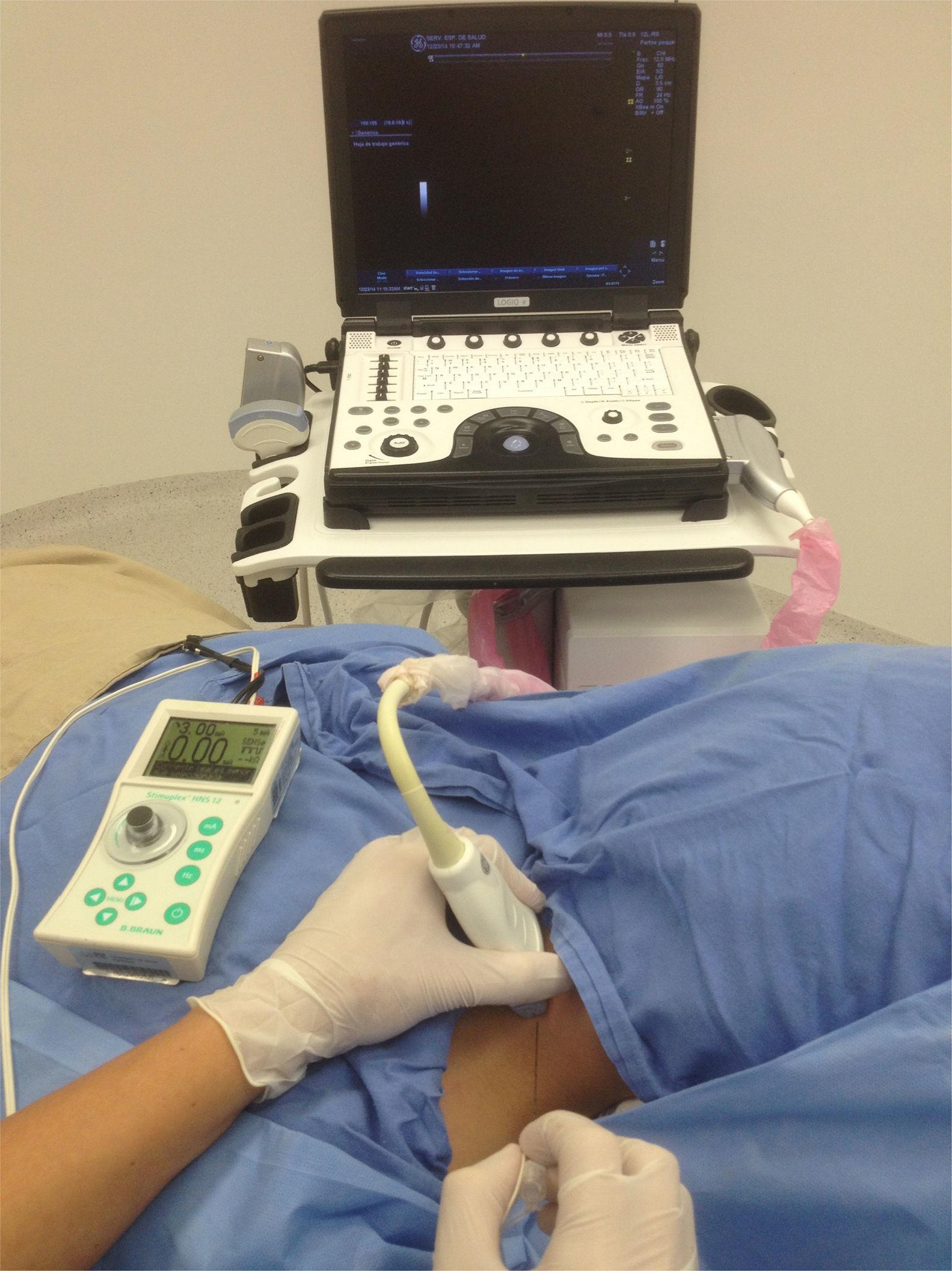 Ergonomics in ultrasound-guided nerve blocks | Colombian Journal of ...