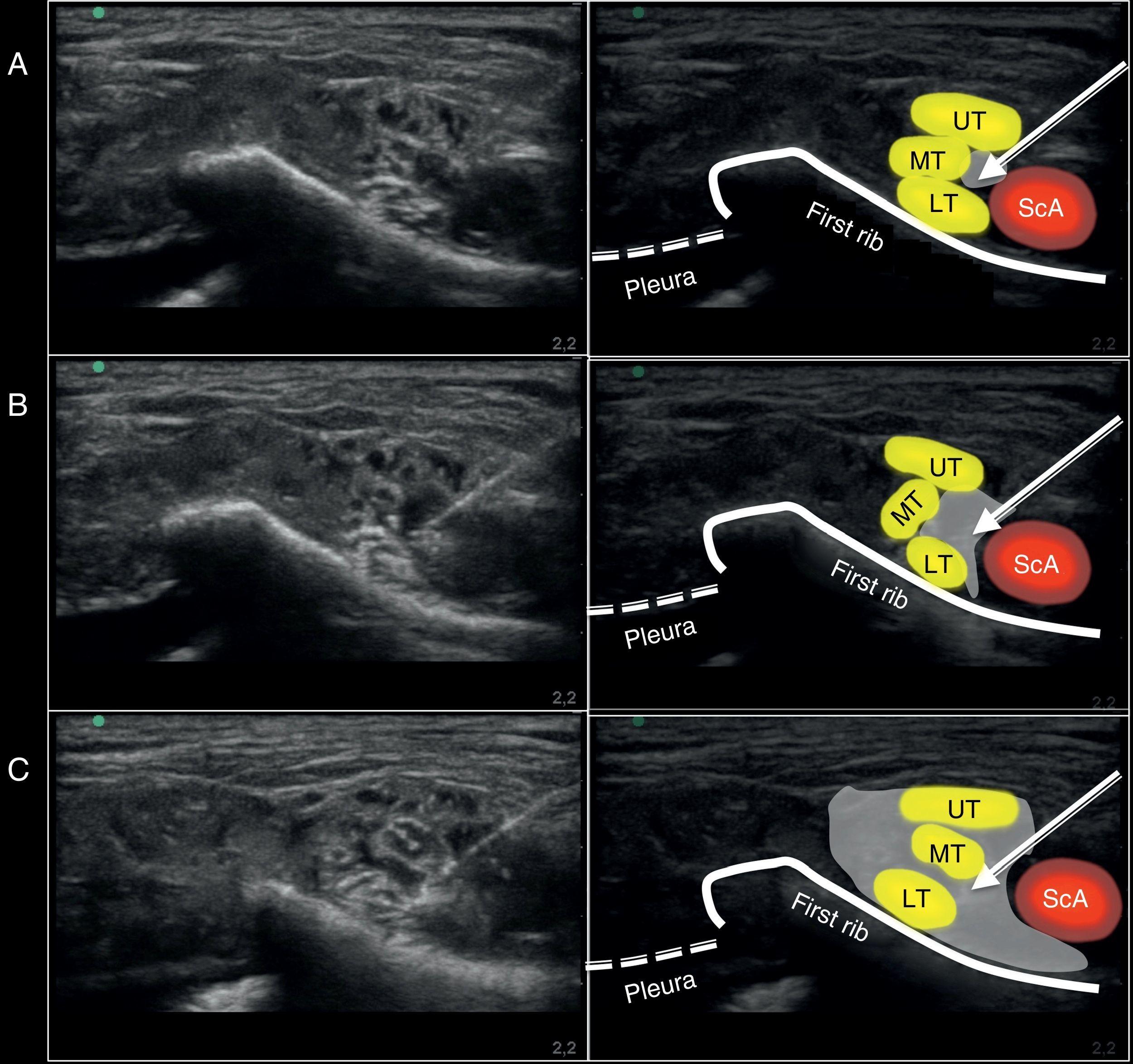 Supraclavicular Nerve Block Ultrasound