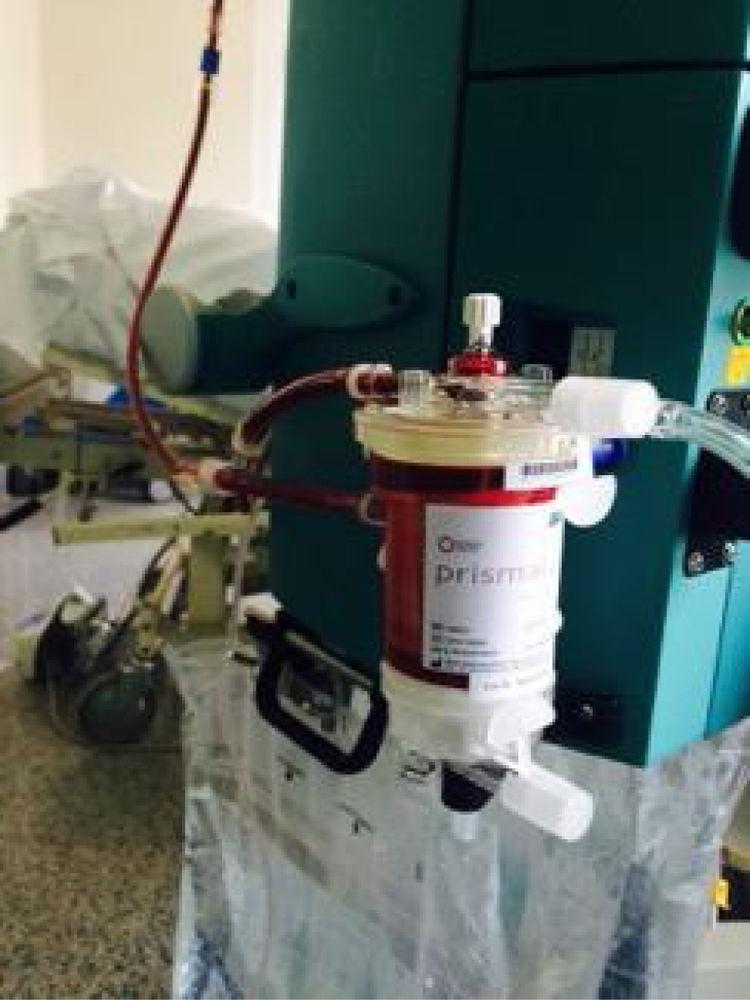 Extracorporeal CO2 removal in a case of respiratory distress syndrome ...