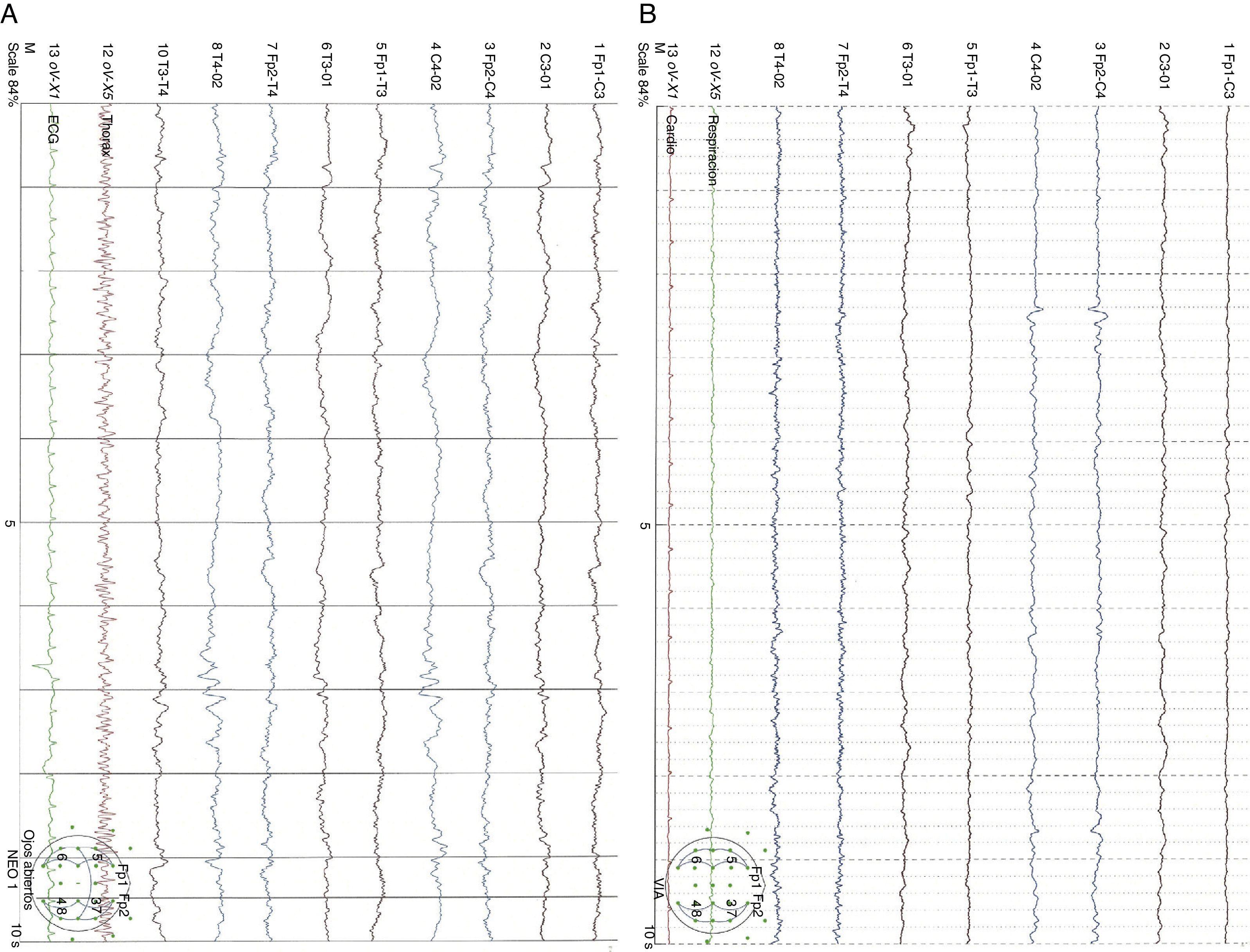 Valproate-induced hyperammonaemic encephalopathy in a neonate ...