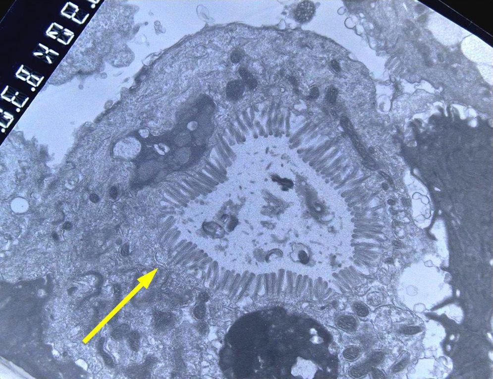 Intestinal failure and transplantation in microvillous inclusion ...