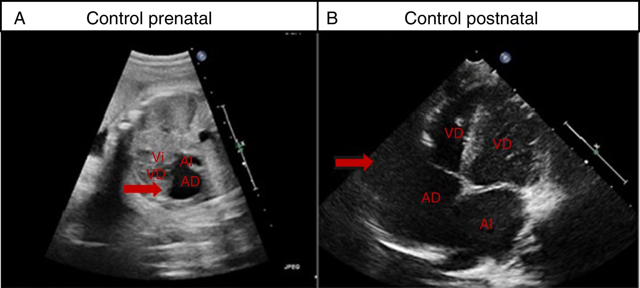 Right (atrial) appendage enlargement: Prenatal diagnosis and postnatal ...