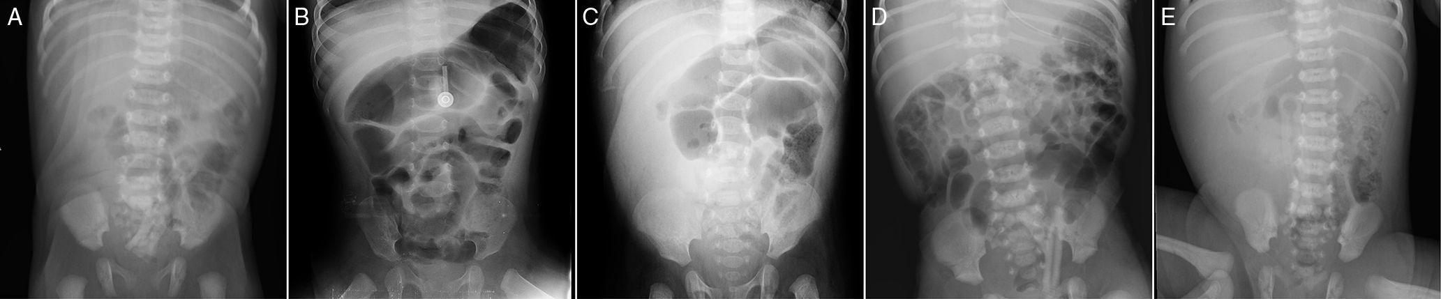 The vomiting infant: When should intestinal volvulus be suspected ...