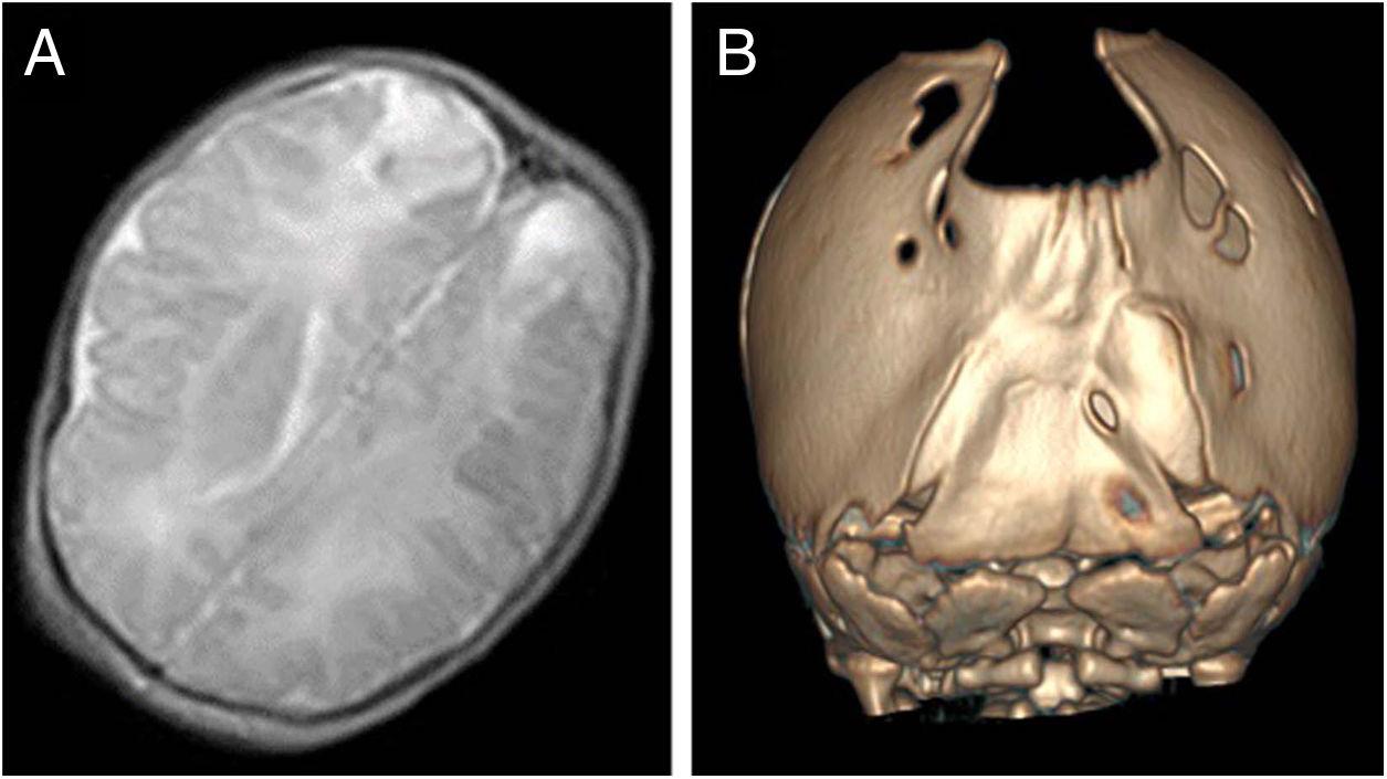 Parietal Foramen