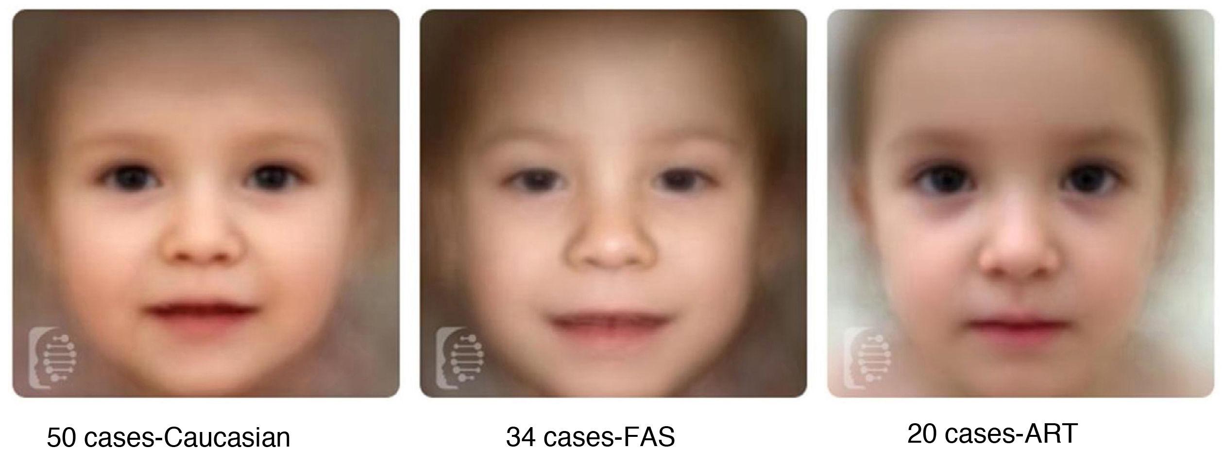 Risk of mayor and minor birth defects in children conceived by assisted ...