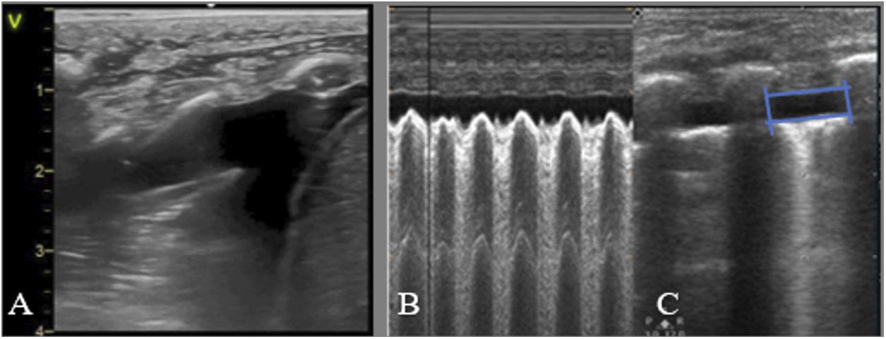 Usefulness of lung ultrasound in the diagnosis and follow-up of ...