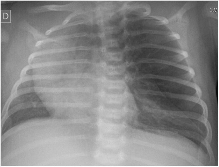 Congenital lobar emphysema simulating a pneumothorax | Anales de Pediatría