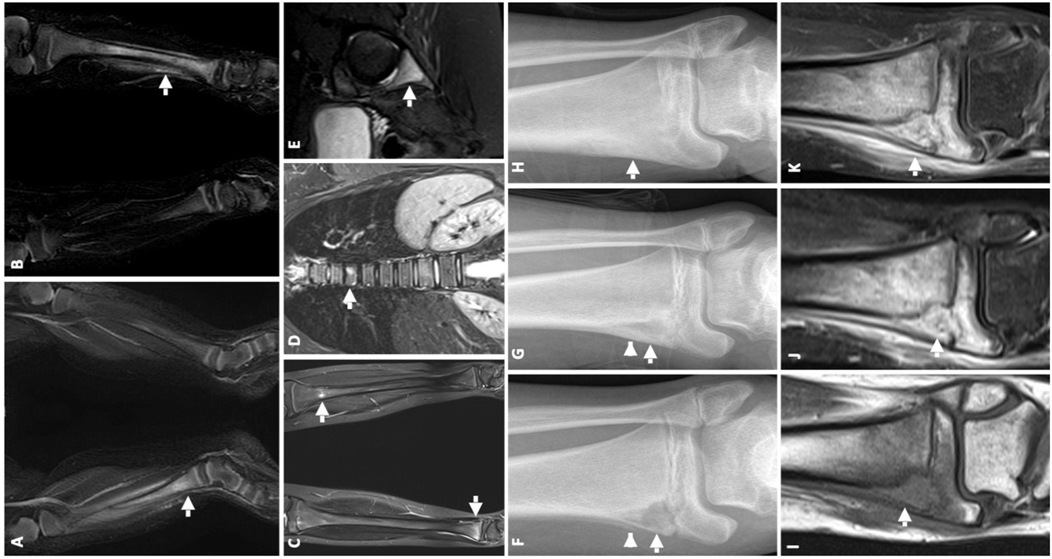 Chronic recurrent multifocal osteomyelitis: Keys to diagnosis | Anales ...
