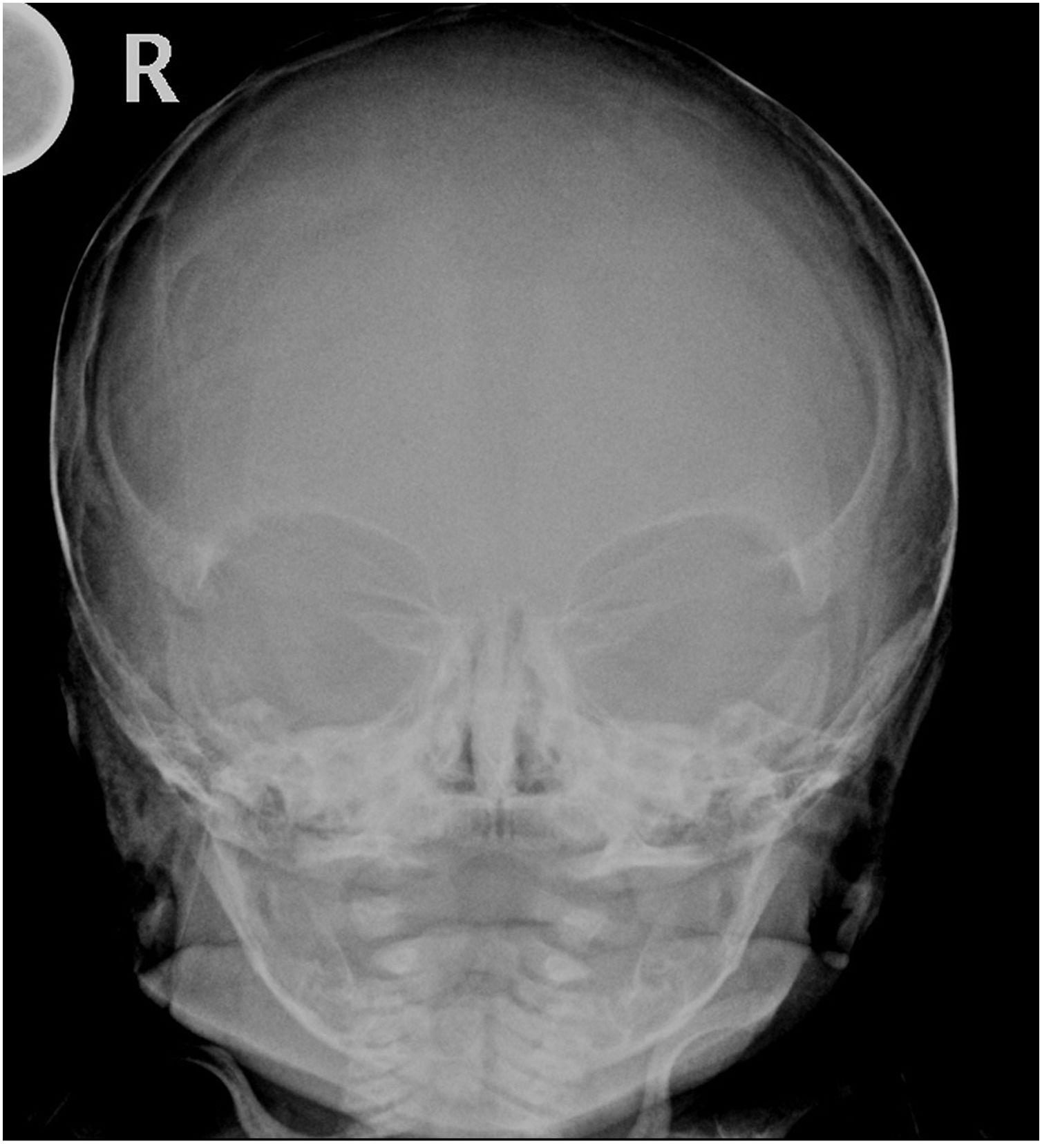 Neonatal lacunar skull as an isolated finding | Anales de Pediatría