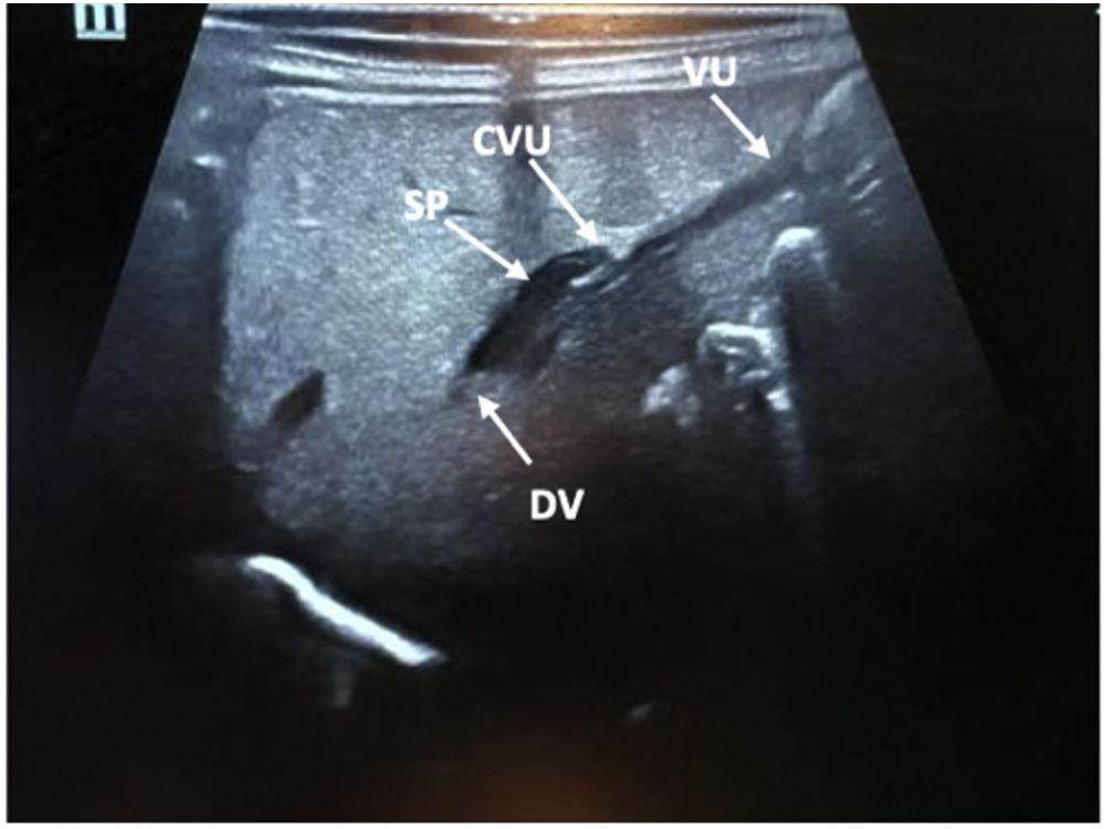 Steps to improve umbilical vein catheterization in neonatal care ...