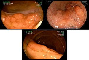 Large Colorectal Lesions: Evaluation and Management | GE - Portuguese ...