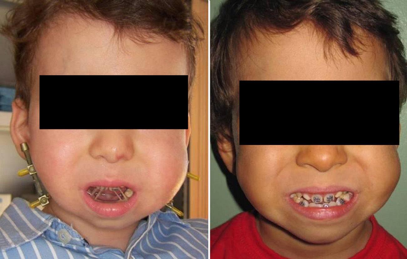 Changes in airway dimensions after mandibular distraction in patients ...