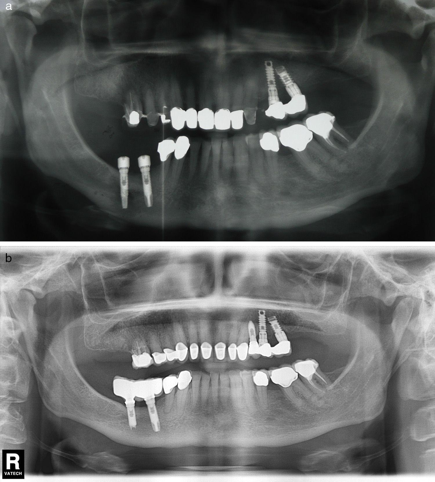Apical peri-implantitis: A presentation of a series of 11 clinical ...