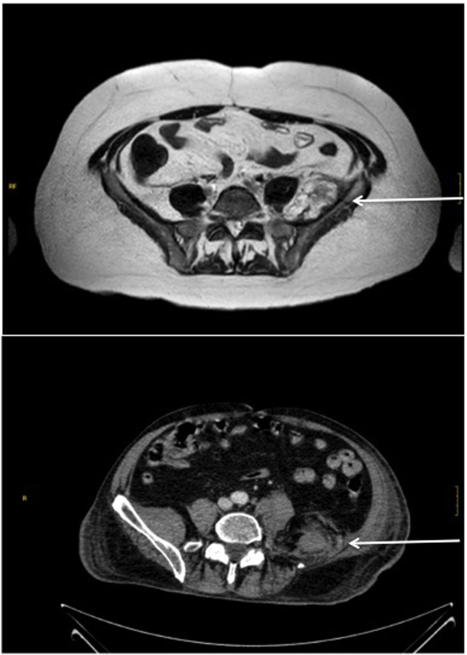 Psoas Hematoma