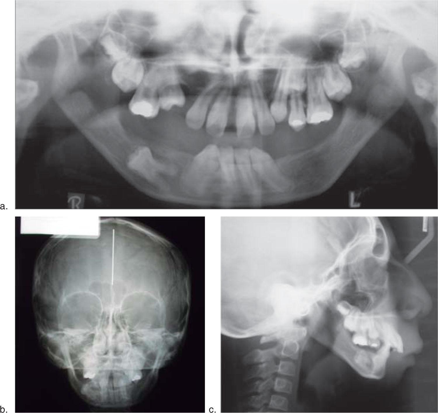 Osteogenic mandibular distraction in Nager’s Syndrome. Case report ...