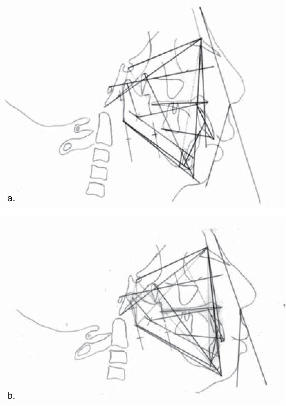 Osteogenic mandibular distraction in Nager’s Syndrome. Case report ...