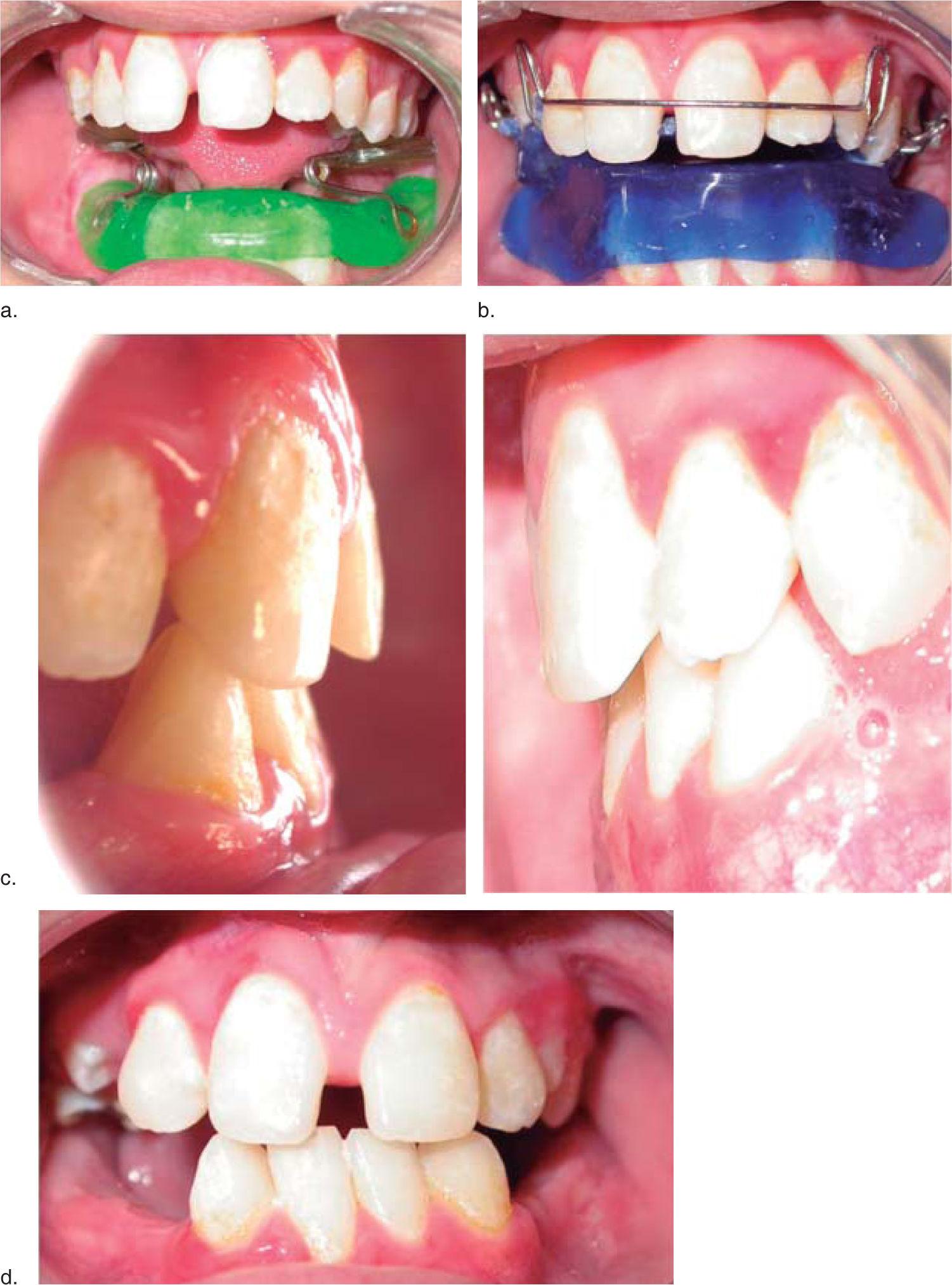Osteogenic mandibular distraction in Nager’s Syndrome. Case report ...