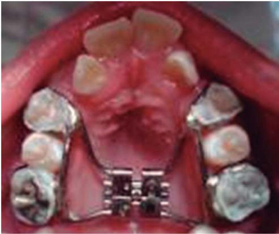 Orthodontic traction of a retained upper canine with Edgewise ...