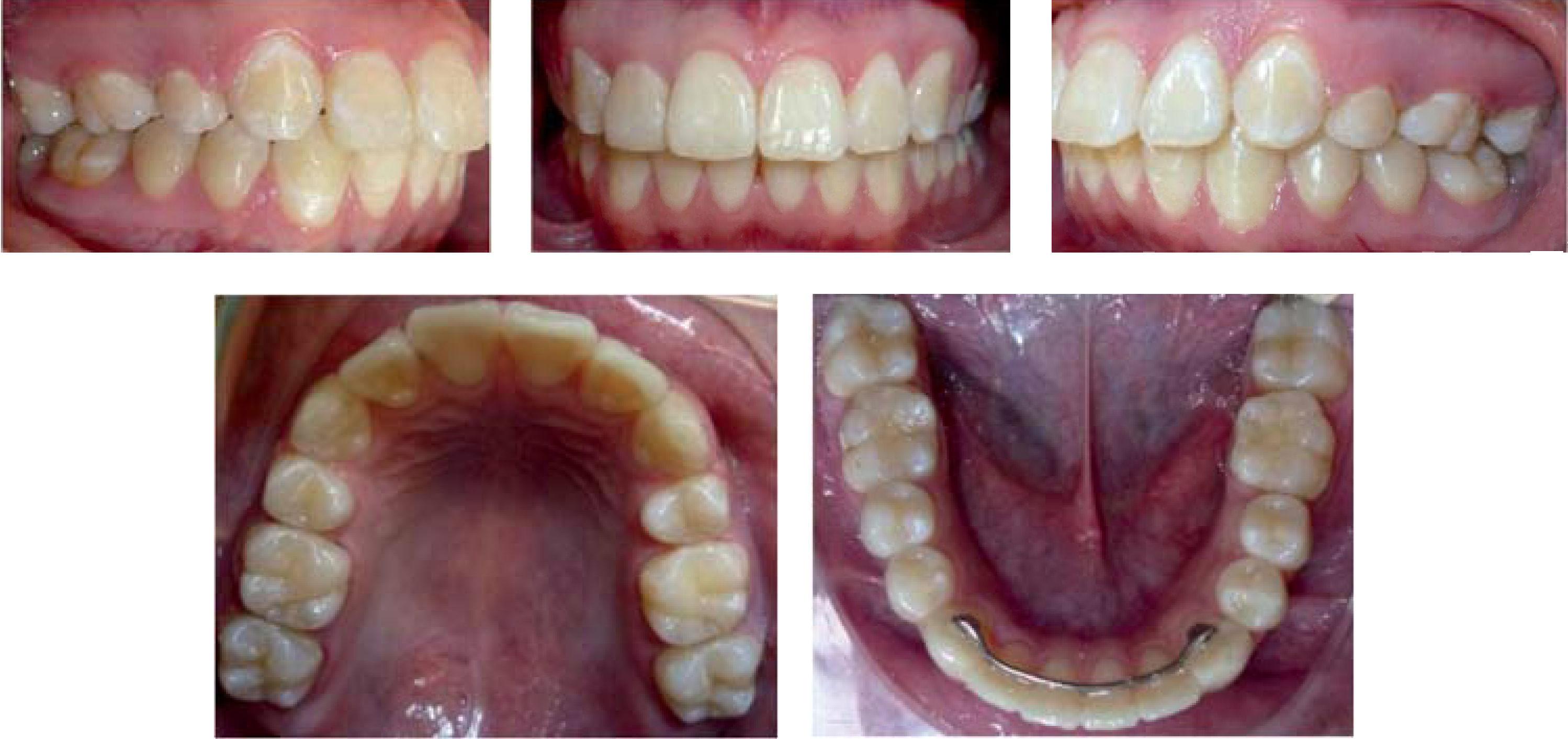Treatment of a class II division 1 malocclusion in an adult patient. A ...