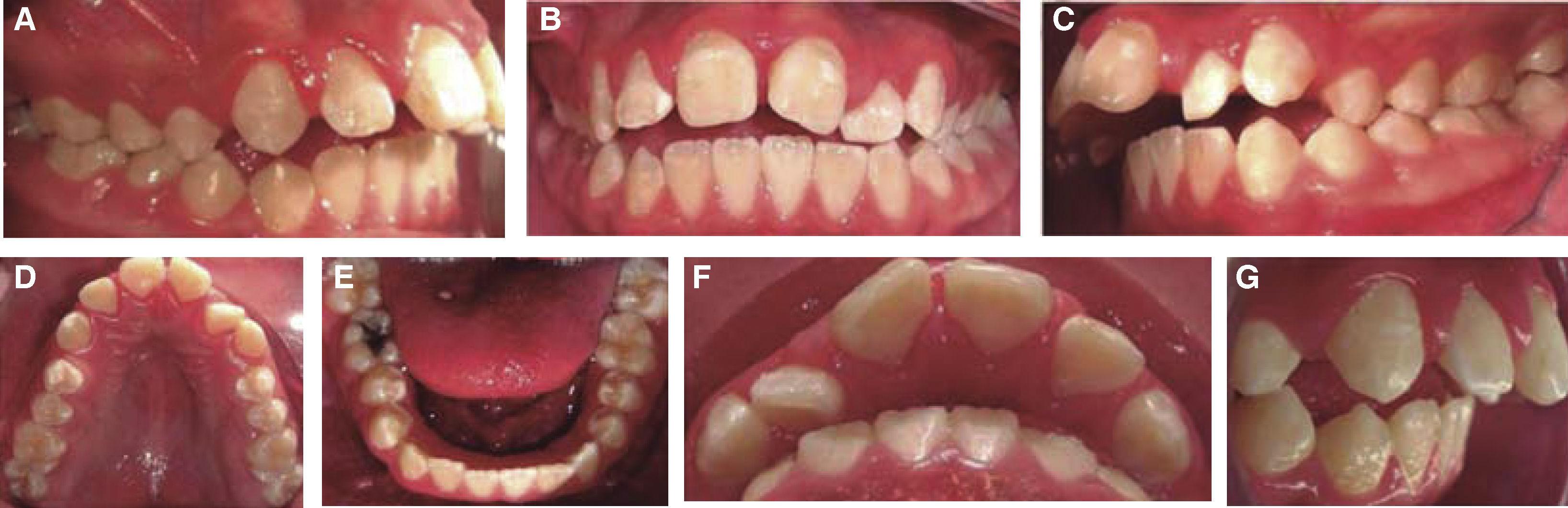 Camouflage orthodontic treatment in an autistic class II patient with ...