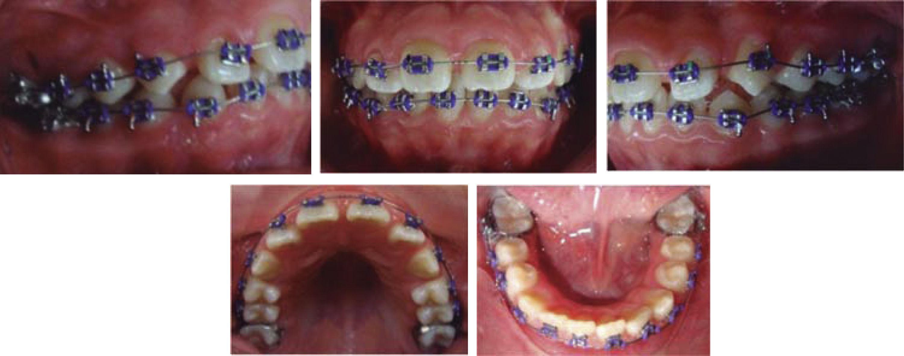 Control vertical de un paciente dolicofacial con un ACCO | Revista ...