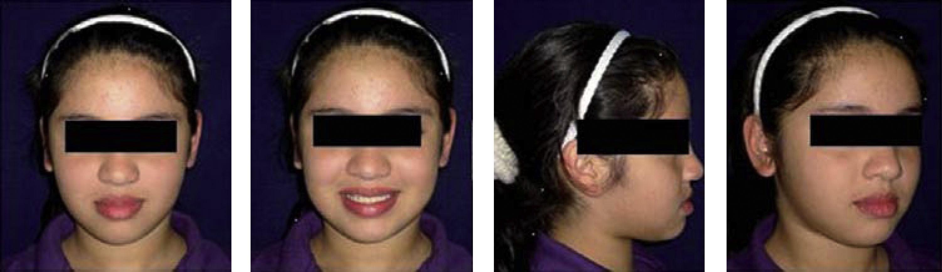 Class III dentofacial alteration treated with camouflage: Clinical case ...