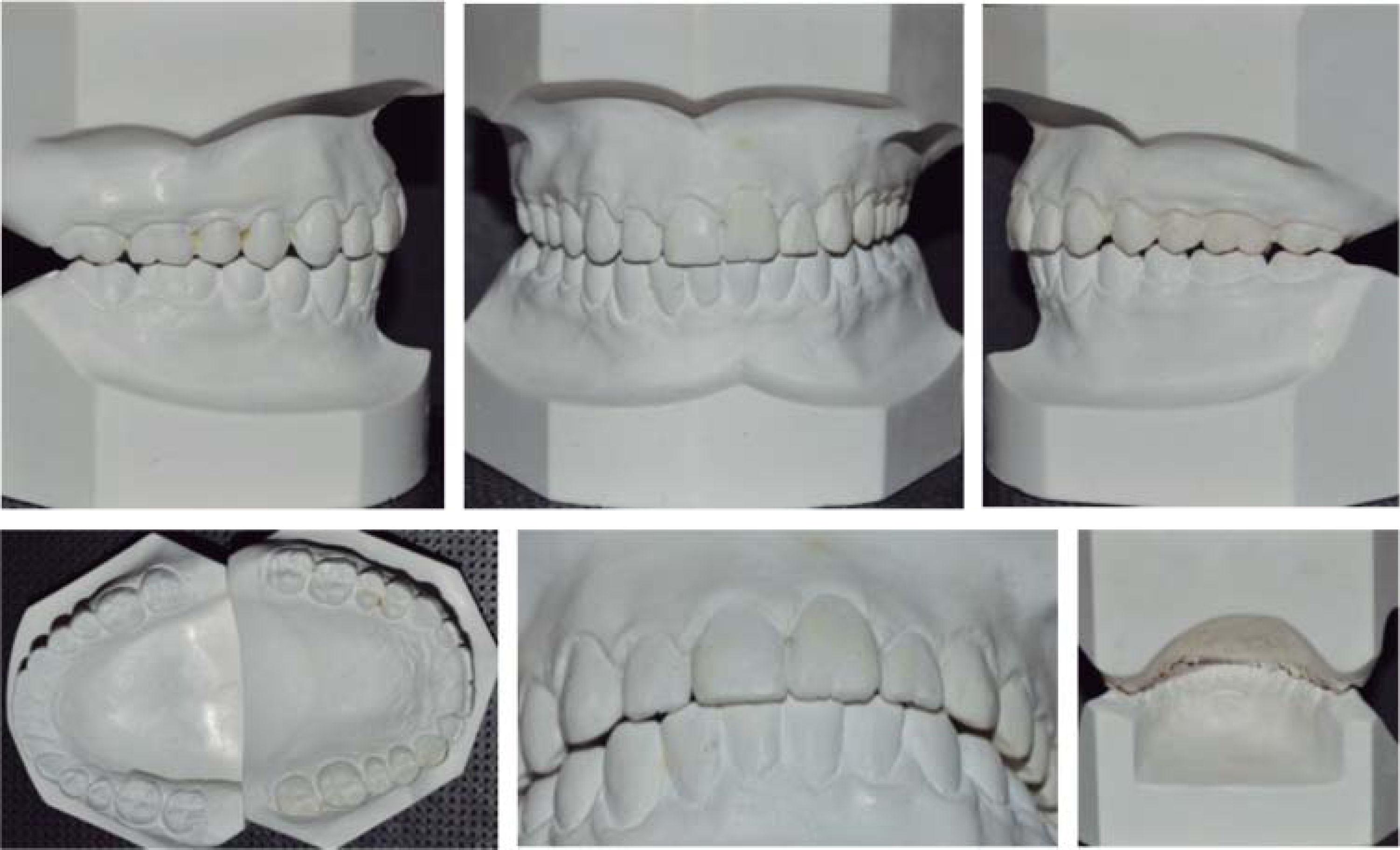 Manejo ortodóncico-quirúrgico de un paciente con maloclusión clase II ...