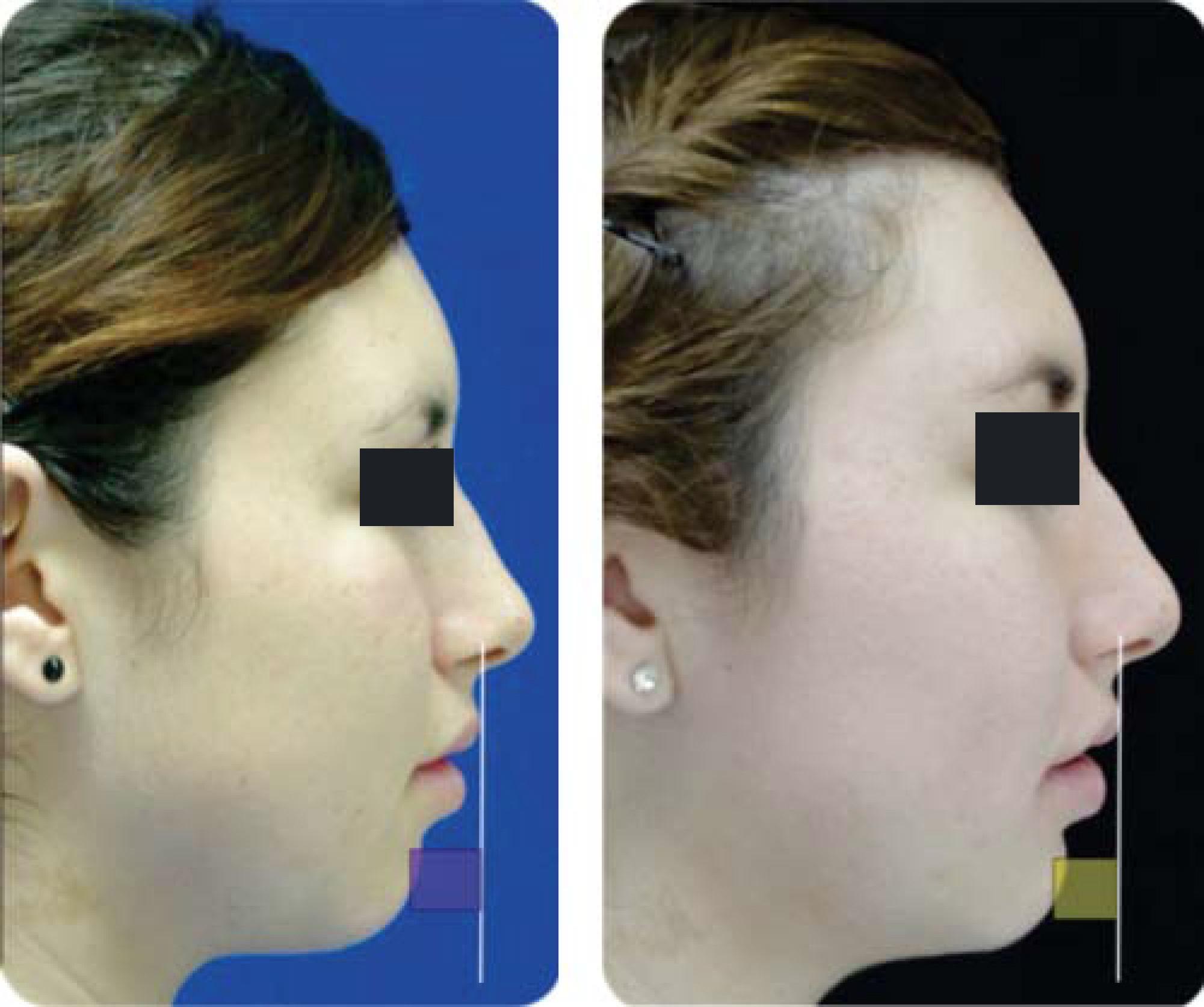 Open bite treatment with first molar extraction. Case report | Revista ...