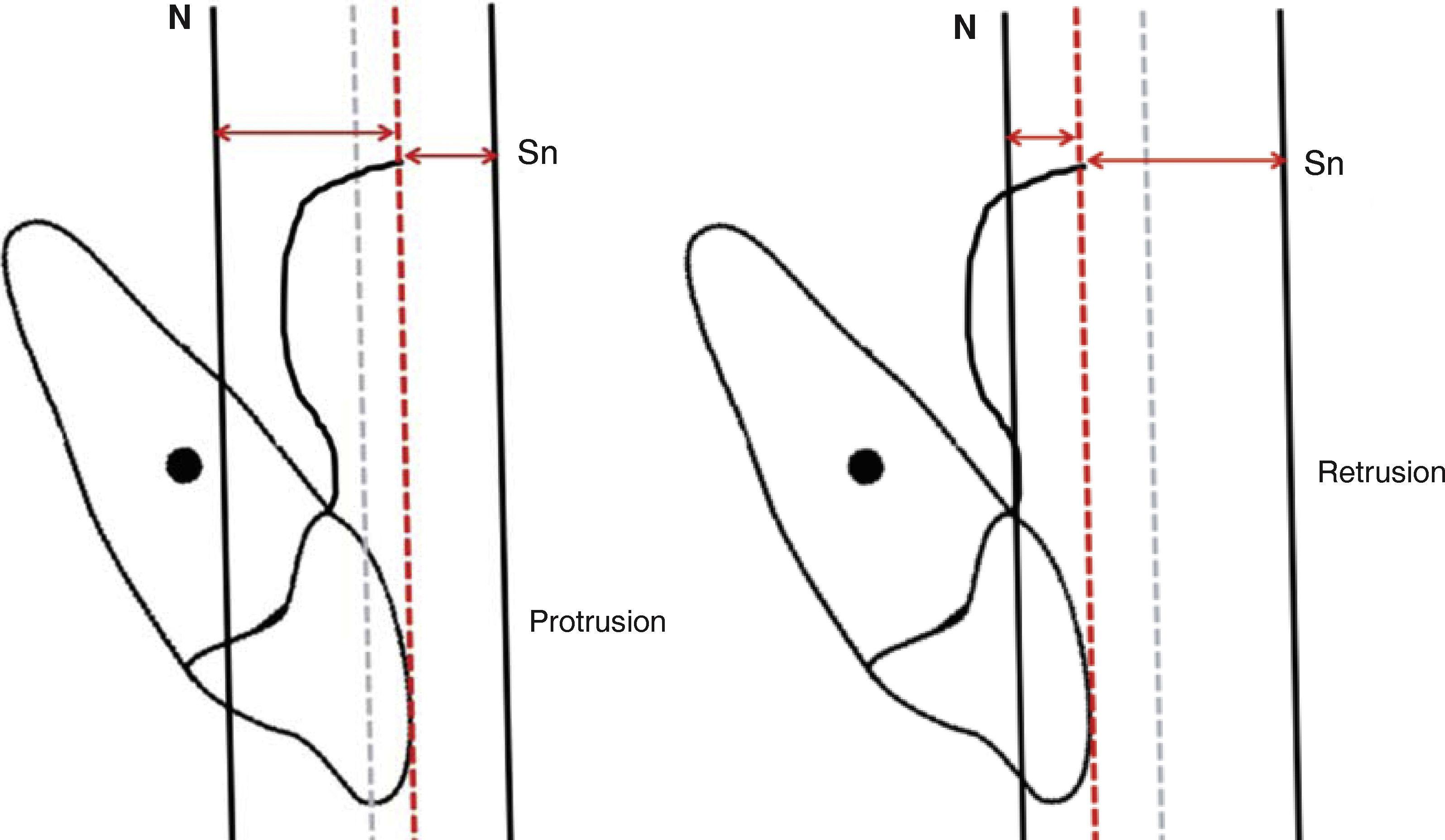 Sagittal cephalometric diagnosis using Power Point (Microsoft® Office ...