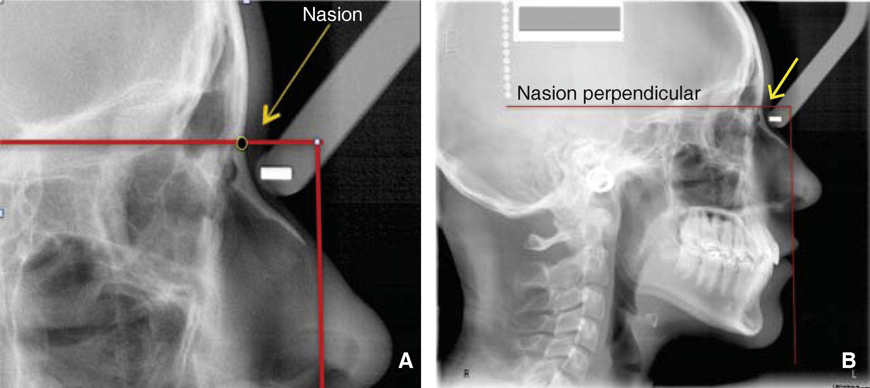 Sagittal cephalometric diagnosis using Power Point (Microsoft® Office ...