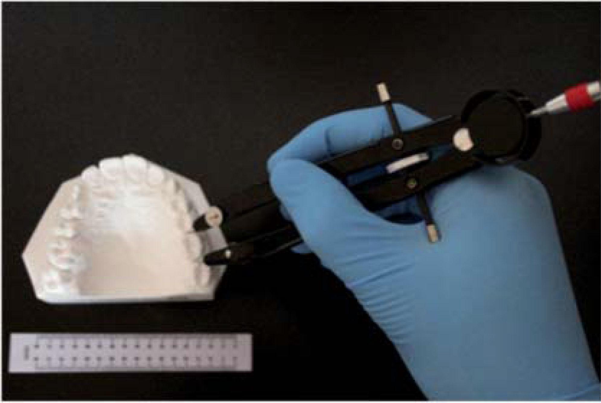 Bolton's index efficacy with manual vs digital measurements | Revista ...