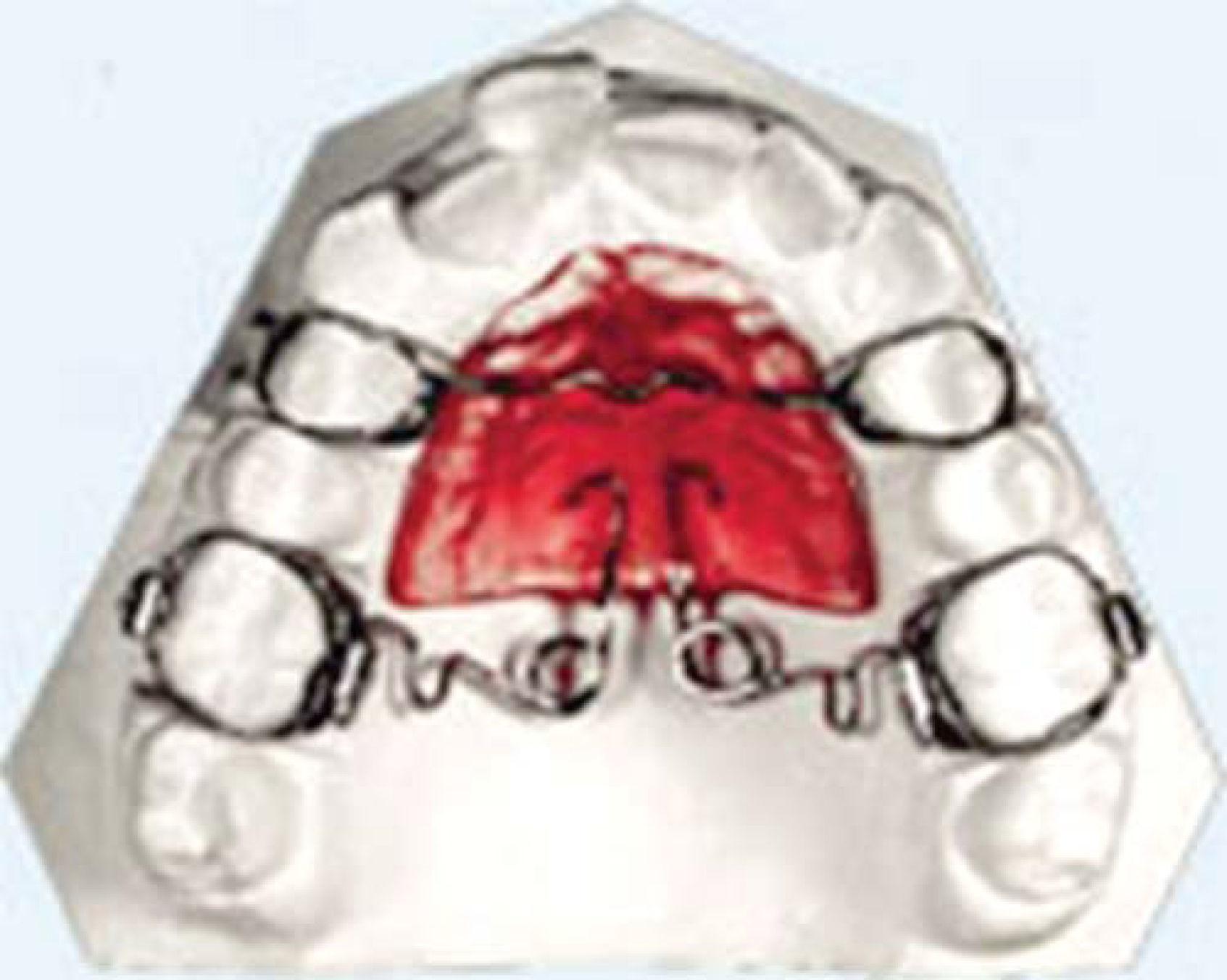 Use of pendulum for molar distalization: Case report | Revista Mexicana de Ortodoncia