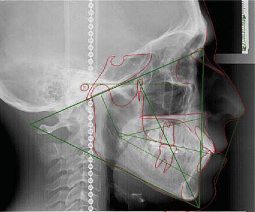 Bilateral posterior telescopic crossbite correction through the use of ...