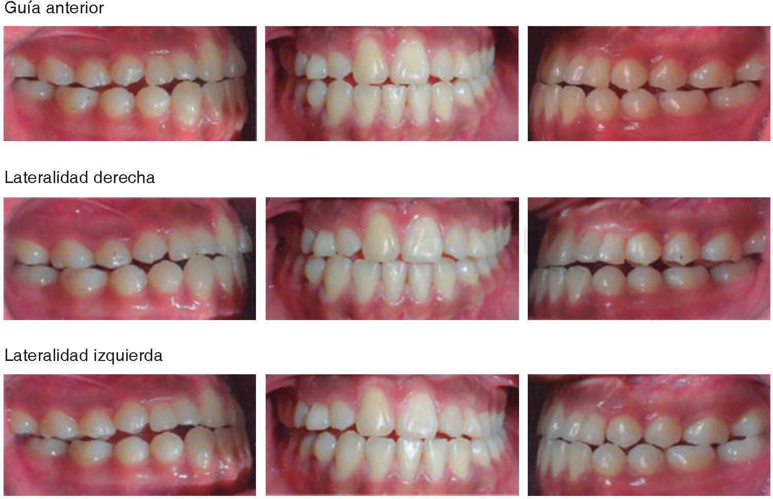 Orthodontic management of the patient with multiple dental inclusions ...