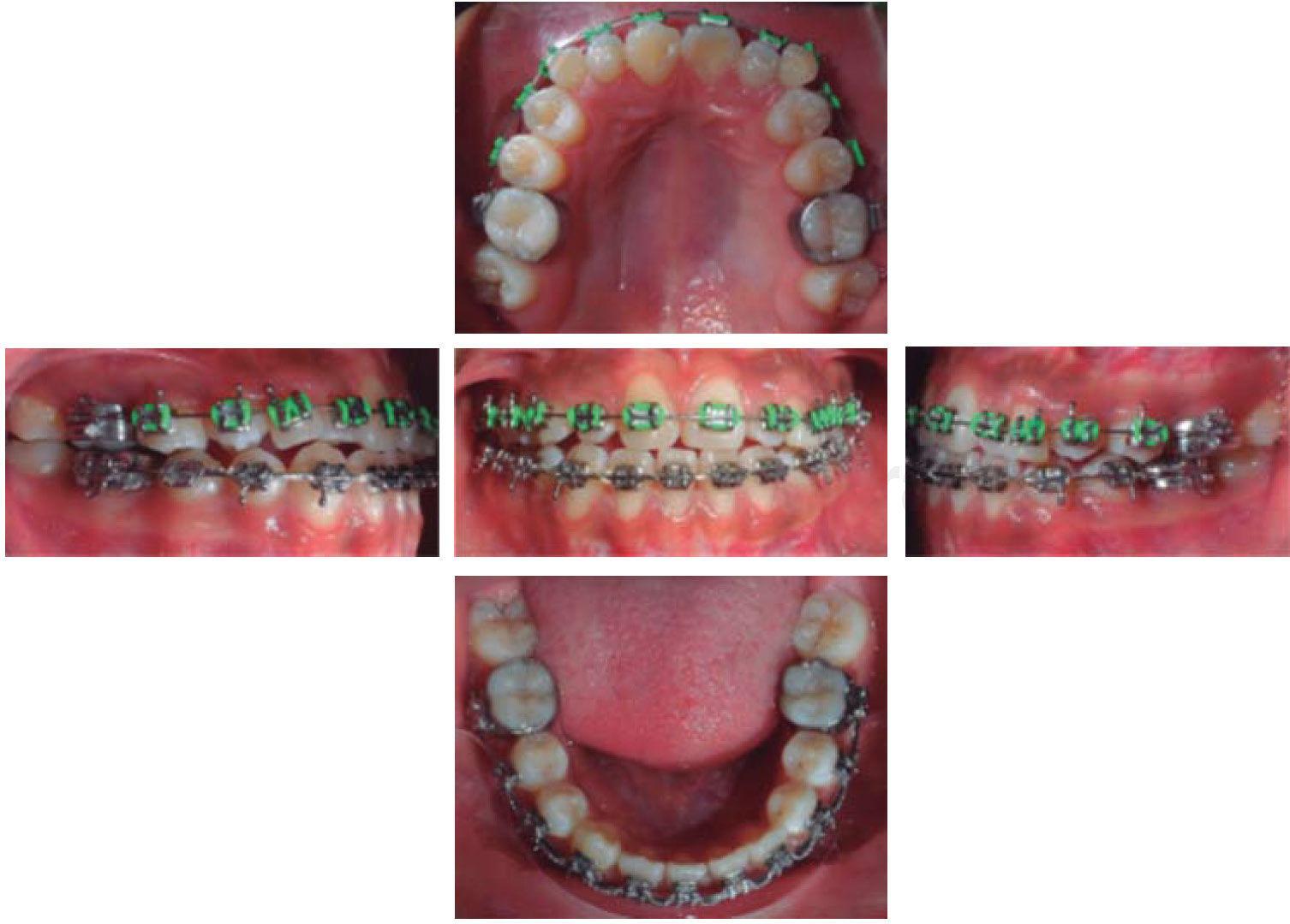 Orthodontic management of the patient with multiple dental inclusions ...
