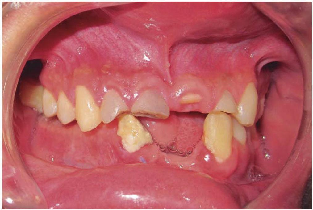 Technical description subapical osteotomy in the treatment of ...
