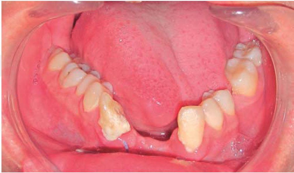 Technical description subapical osteotomy in the treatment of ...