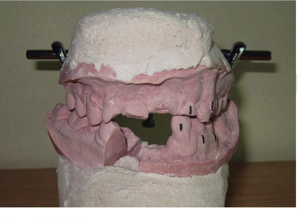 Technical description subapical osteotomy in the treatment of ...