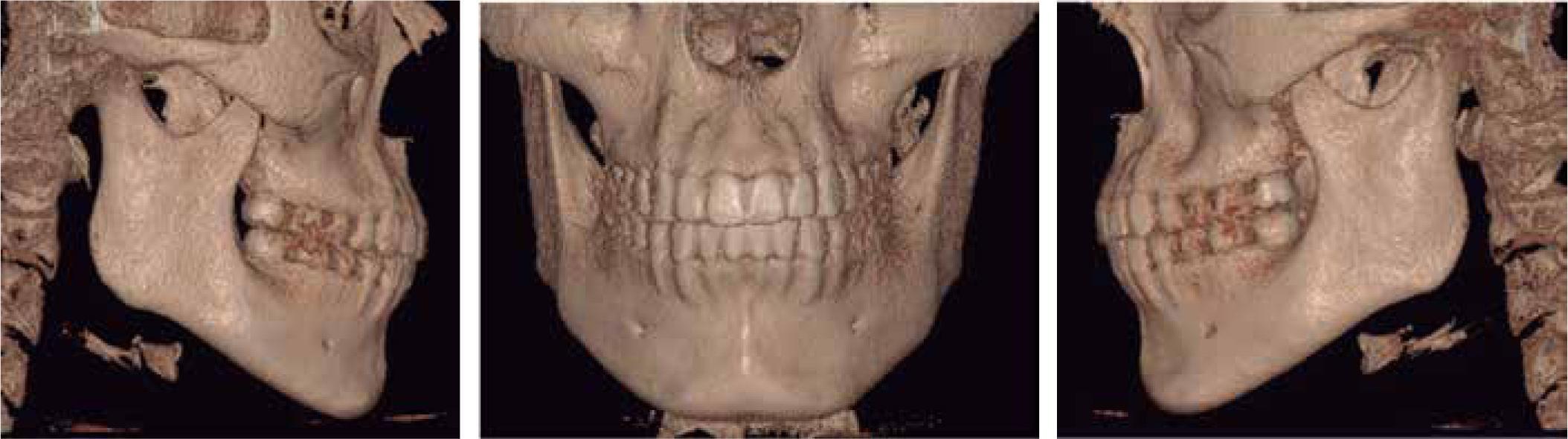 Correction of an skeletal anterior open bite with mini-screws and a ...