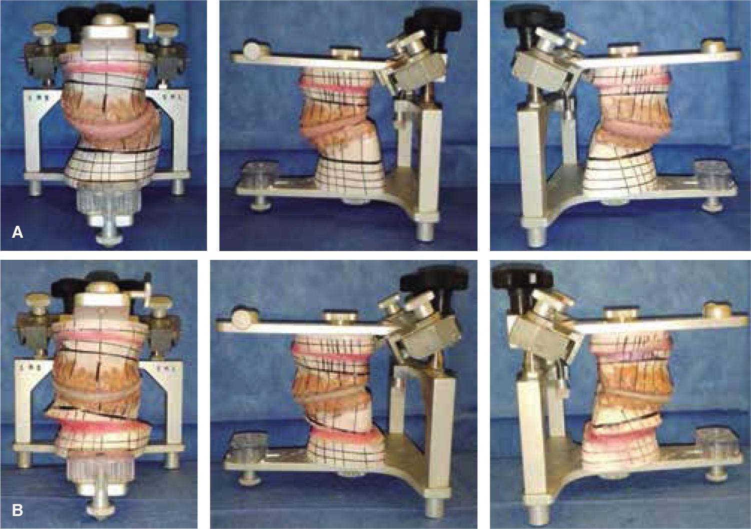 Surgical-orthodontic treatment in a skeletal class III patient with ...