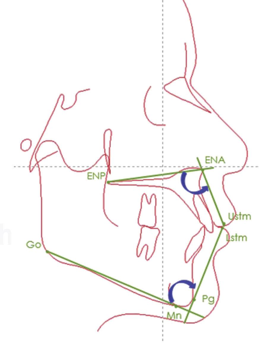 Proposition of two cephalometric angles for assessing lip position ...