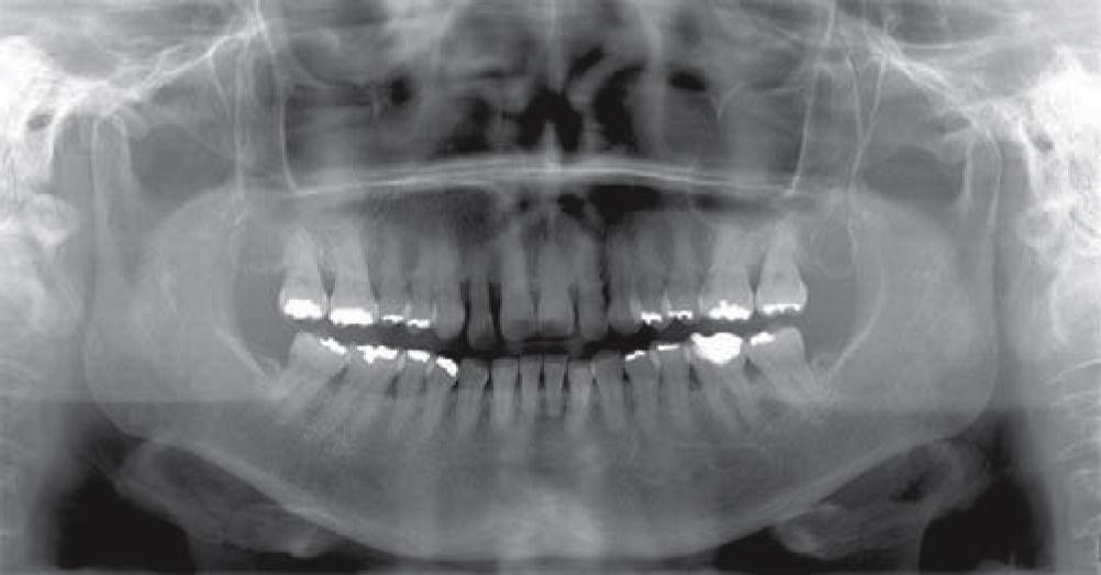 Tooth Intrusion Radiograph