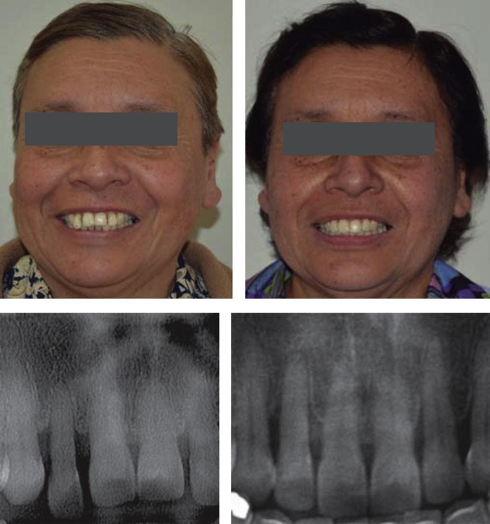 Bone increase in a vertical defect through orthodontic intrusion in an ...