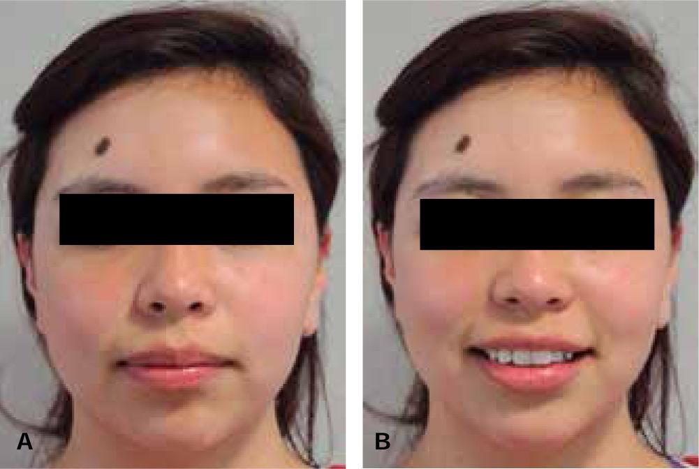 Tratamiento ortodóncico-quirúrgico de paciente clase II división 1 ...