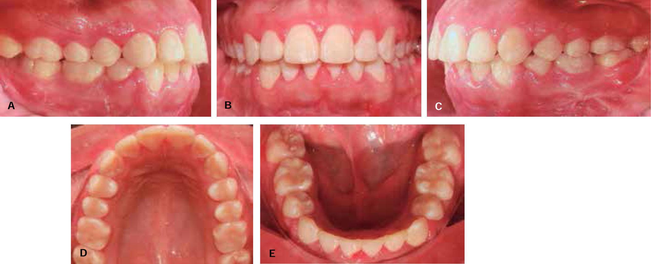 Orthodontic-surgical treatment of a class II division 1 patient. Case ...