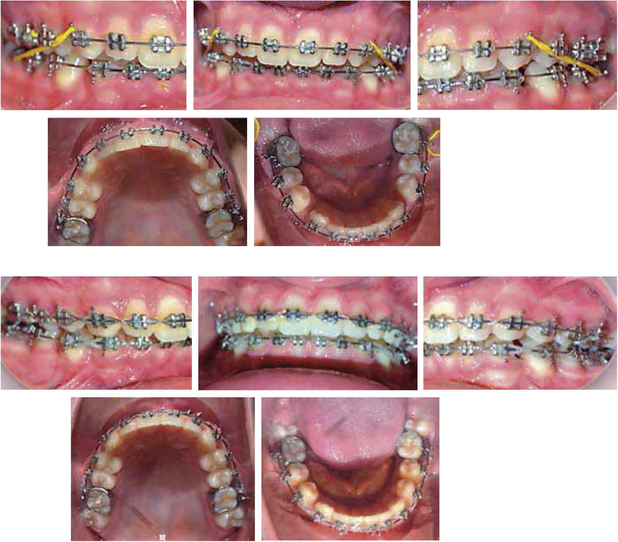 Treatment of irregular interdental spaces in a skeletal class II using ...