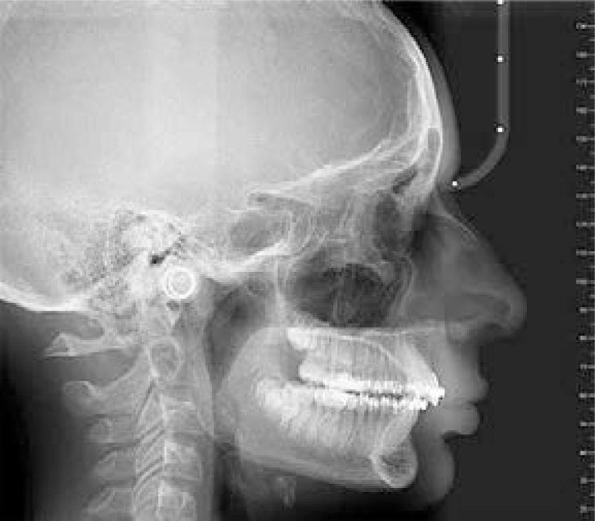 Treatment of irregular interdental spaces in a skeletal class II using ...