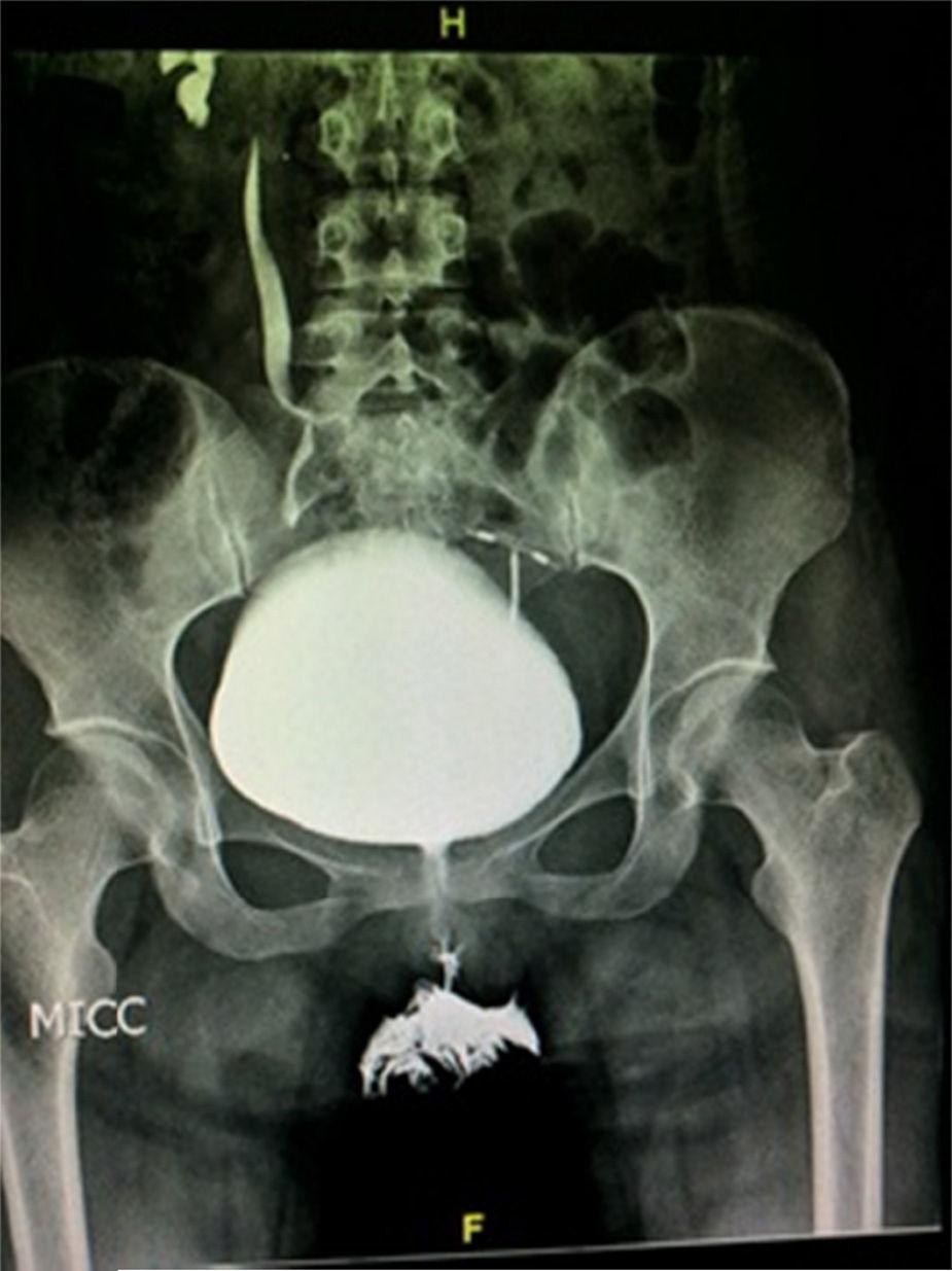 Acute urinary retention secondary to giant prolapsed ureterocele in a ...