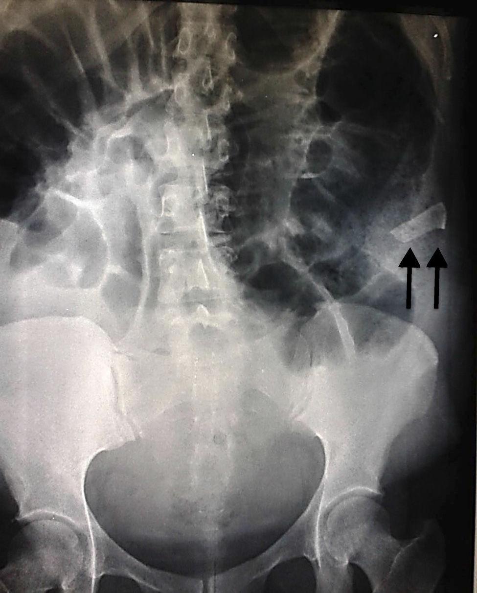 Intestinal occlusion secondary to a retained surgical item | Cirugía y ...