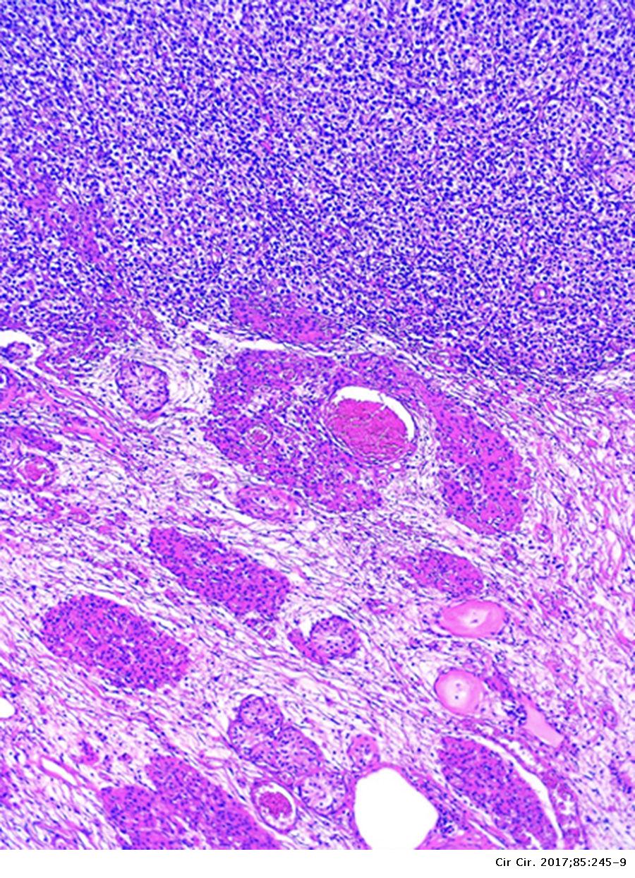 A Woman With A Pure Seminoma And A Contralateral Intratubular Germinal